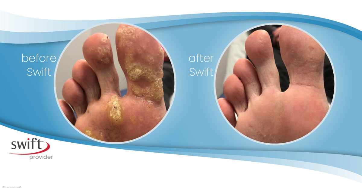 Warts & Verrucae Treatment at Cornwall Podiatry